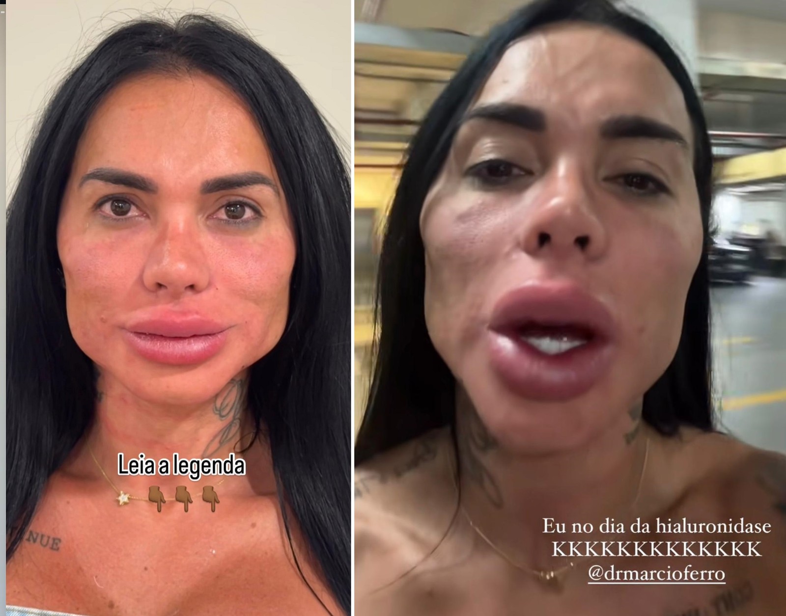 Gretchen comemora novo rosto após aplicação de fios de silhouette