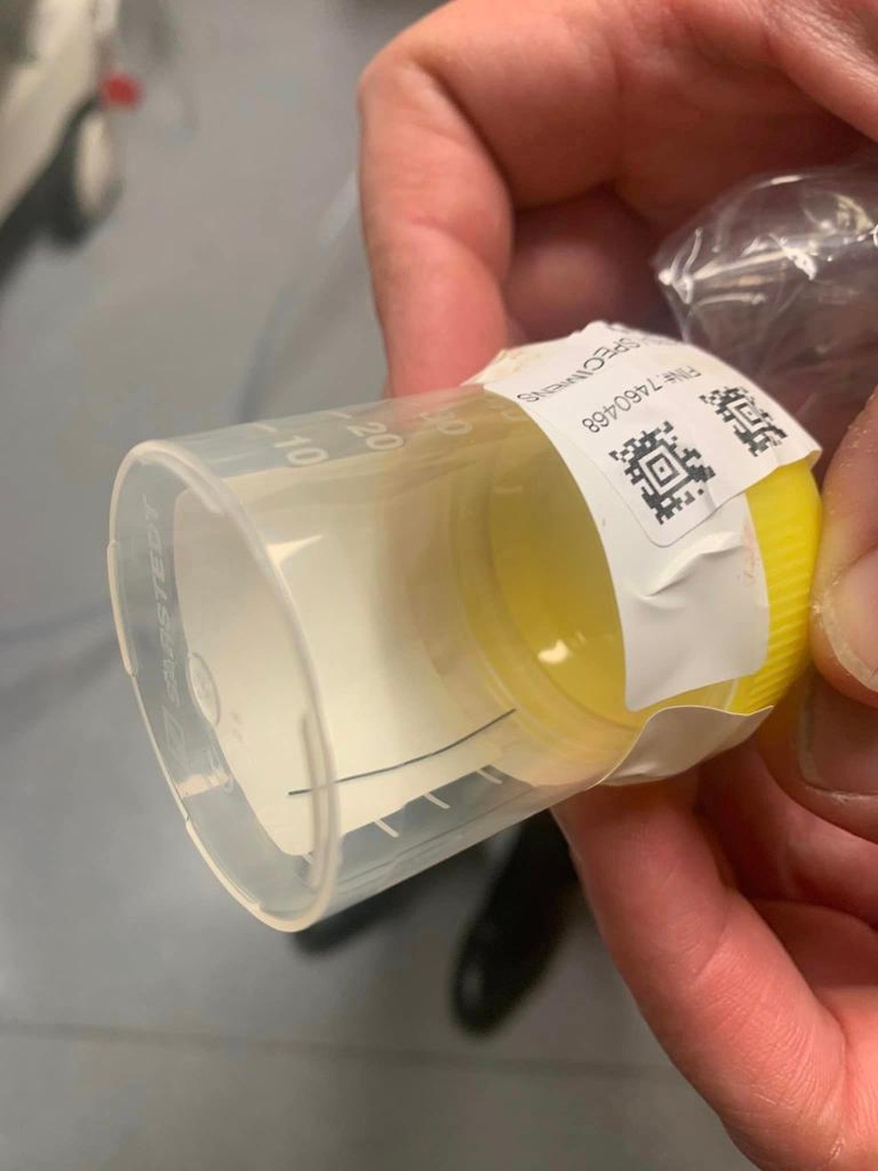 Cerda de pincel para churrasco fica alojada no esôfago de menina e ...