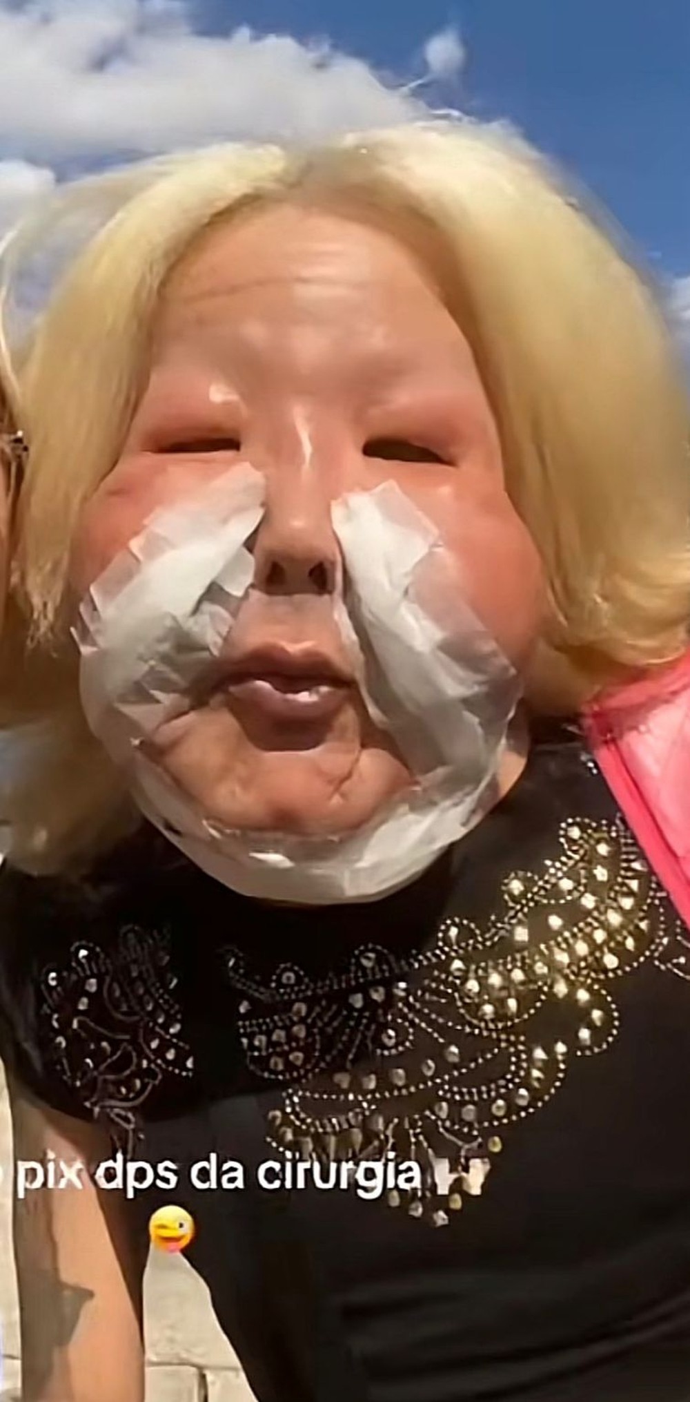 Juju do Pix mostra rosto, dez dias após cirurgia para retirar óleo ...