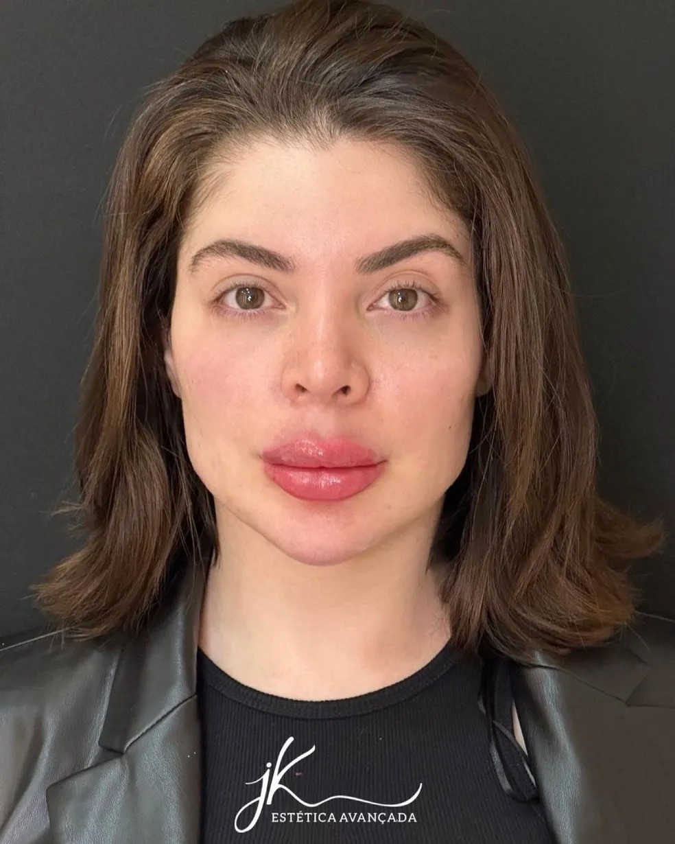 Ex-BBB Íris Stefanelli faz cirurgia no rosto: 'Nada de rugas'