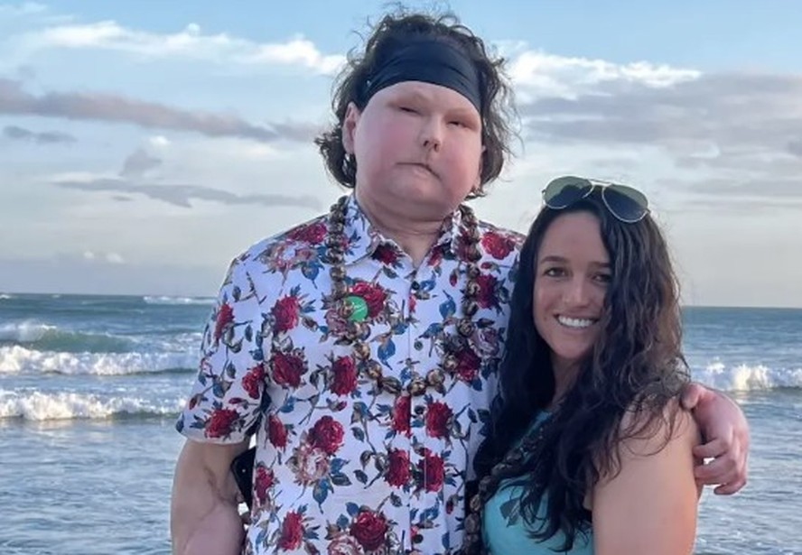 Primeiro a passar por transplante de rosto e mãos comemora 'ter ...