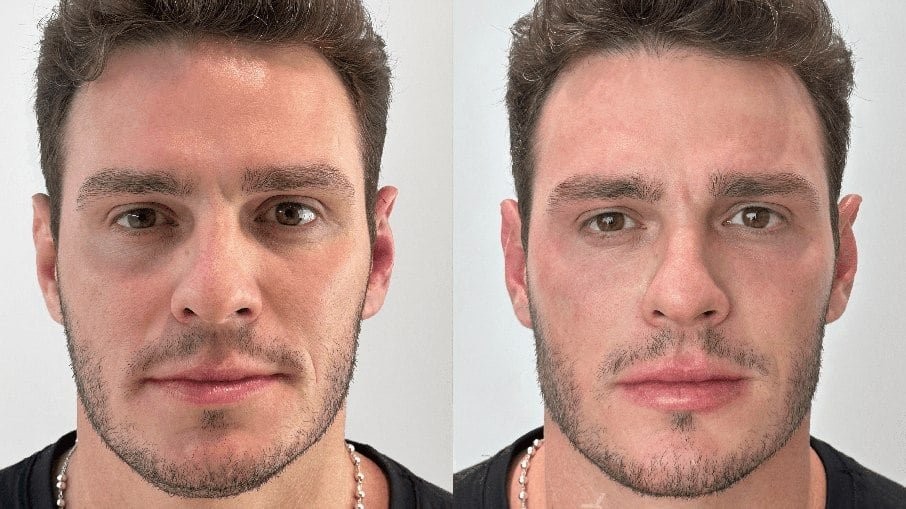 Mauricio Mattar faz nova harmonização facial aos 60 anos; veja antes e ...