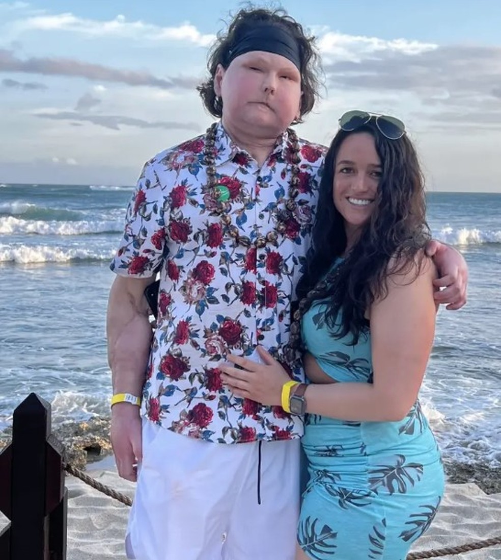 Primeiro a passar por transplante de rosto e mãos comemora 'ter ...