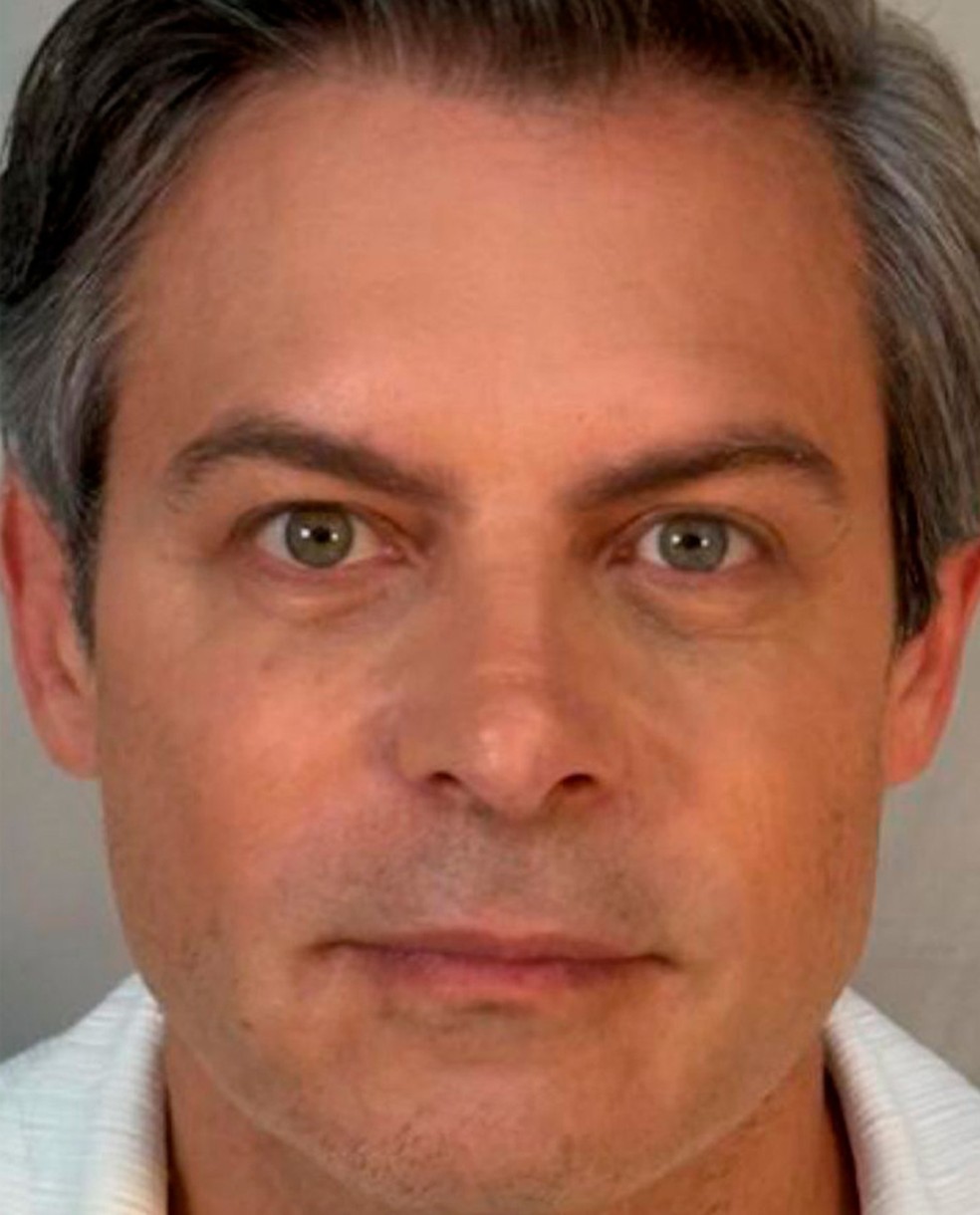 Luigi Baricelli exibe resultado de harmonização facial; veja antes e depois