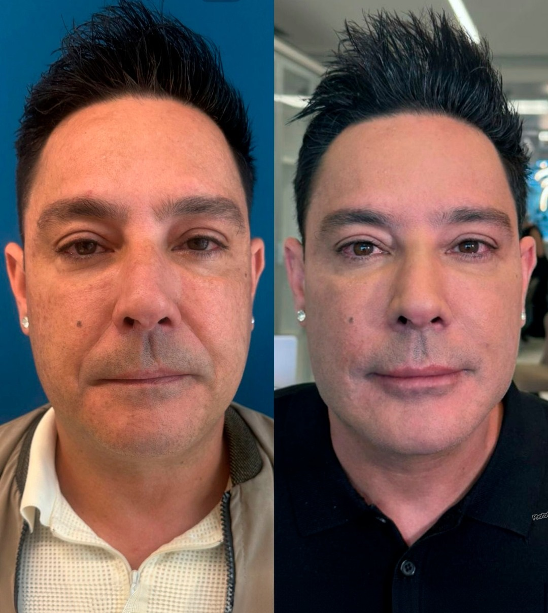 Ex-BBB Íris Stefanelli faz cirurgia no rosto: 'Nada de rugas'