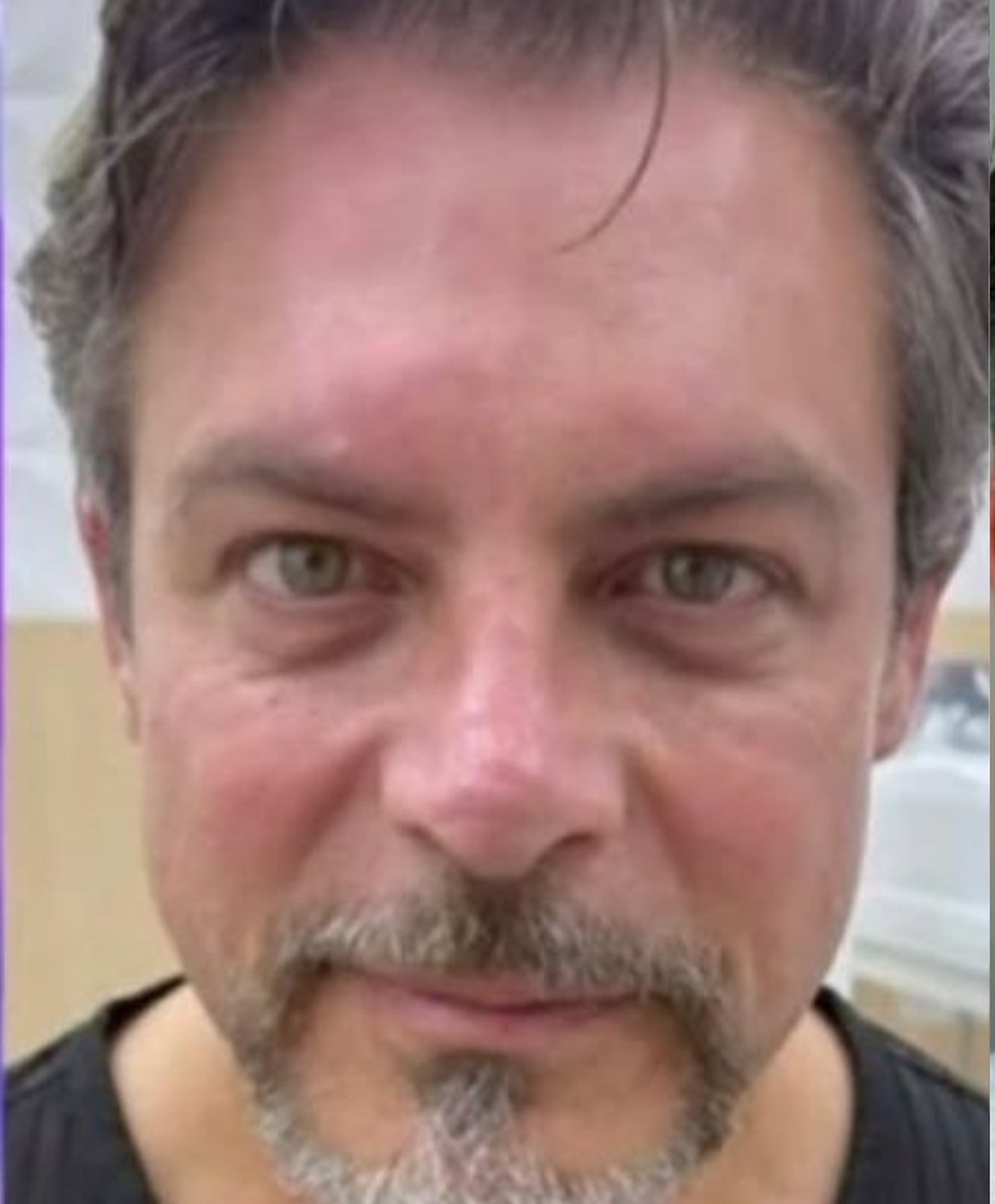 Luigi Baricelli exibe resultado de harmonização facial; veja antes e depois