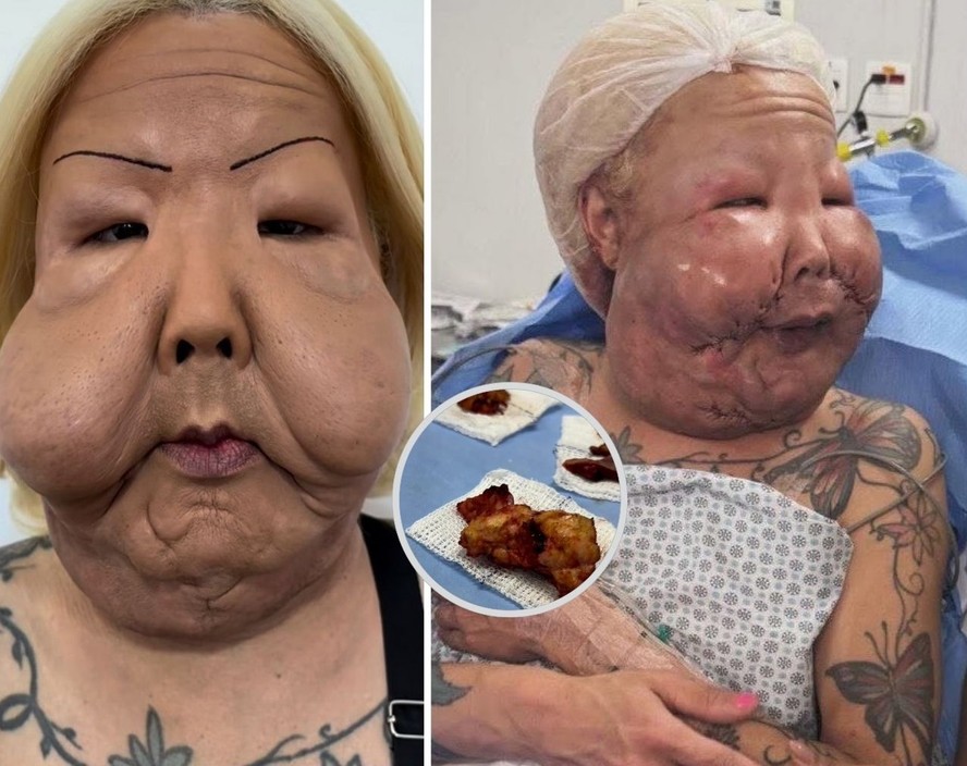 Médico mostra óleo mineral enrijecido retirado do rosto de Juju do Pix ...