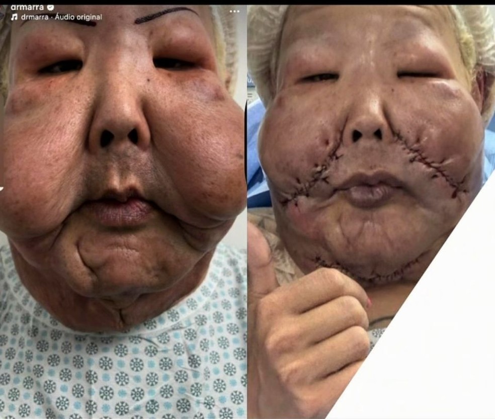 Trans conhecida como Juju do Pix realiza cirurgia de retirada de óleo mineral do rosto e ...