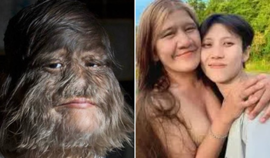 Quinze anos depois, ex-garota mais peluda do mundo aparece bem diferente