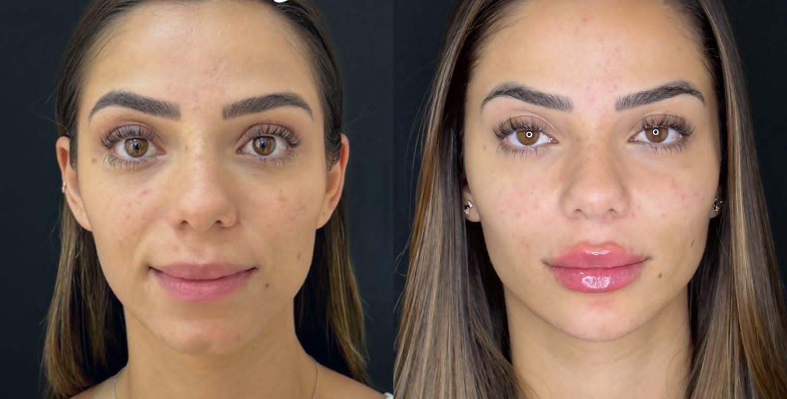 Gretchen comemora 'novo rosto' após aplicação de fios de silhouette ...