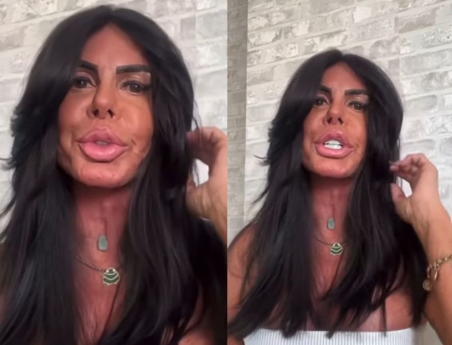 Gretchen mostra rosto 'sem filtro' e resultado da nova harmonização; vídeo