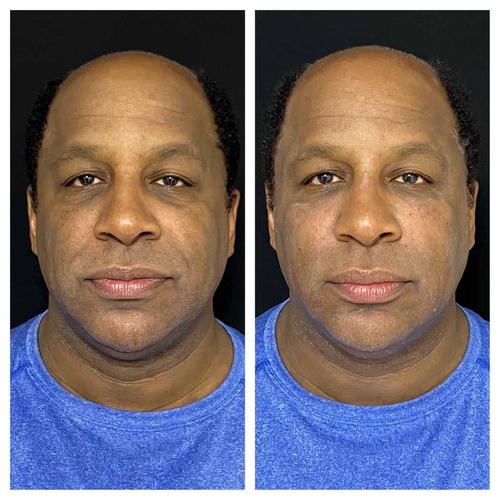 Aílton Graça fez procedimento com o próprio sangue para viver Mussum no ...