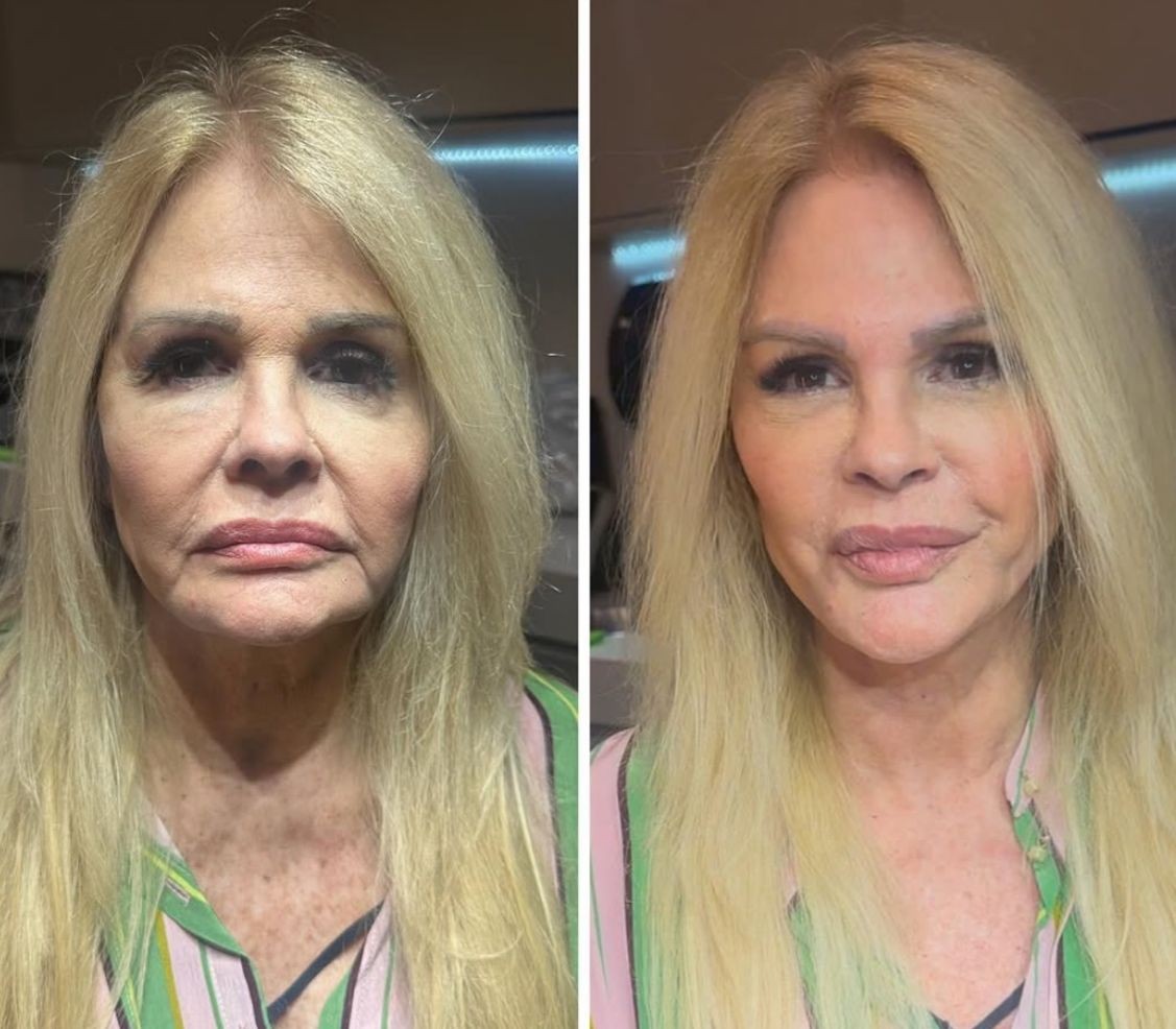 Gretchen comemora 'novo rosto' após aplicação de fios de silhouette ...