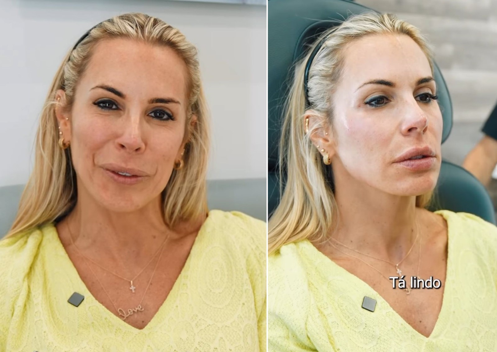 Ex-BBB Íris Stefanelli faz cirurgia no rosto: 'Nada de rugas'