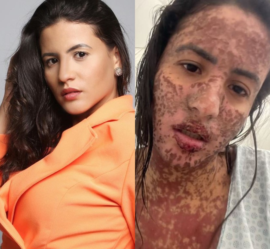 Entenda o que é a síndrome de Stevens-Johnson, doença rara que causou ...