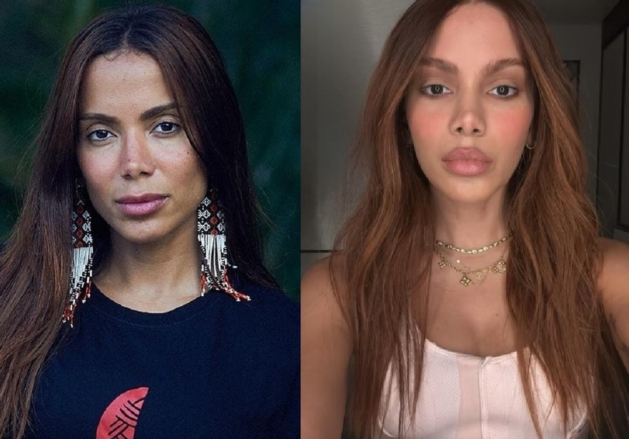 O que Anitta fez no rosto? Especialista cita procedimentos que podem ...