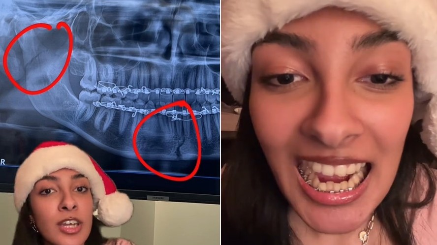 Jovem sofre fraturas no maxilar ao morder doce 'quebra-queixo'