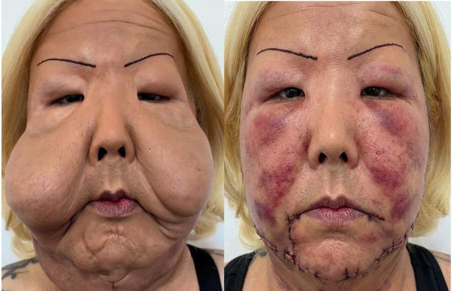 Trans conhecida como Juju do Pix realiza cirurgia de retirada de óleo mineral do rosto e ...